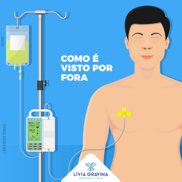 Cateter Totalmente Implantado OU Cateter Port-A-Cath - Dra. Lívia Gravina
